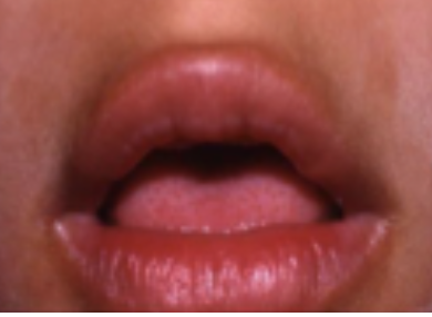 Orofacial Myofunctional Disorders (OMDs) – Smile Myo Therapy-Virtual ...